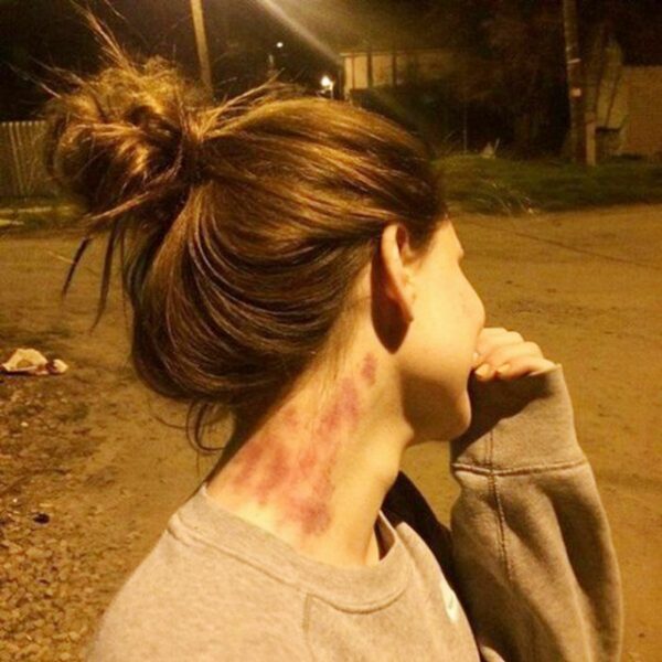 Hickey là gì? Tại sao giới trẻ lại thích thú với hickey kiss?